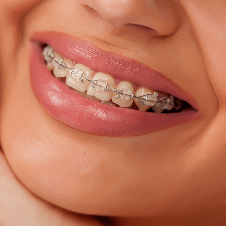 Ειδική Ορθοδοντικός Δρ. Ελίνα Ιωάννου - Orthosmile Orthodontics