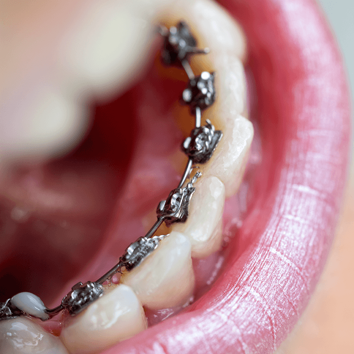 Ειδική Ορθοδοντικός Δρ. Ελίνα Ιωάννου - Orthosmile Orthodontics