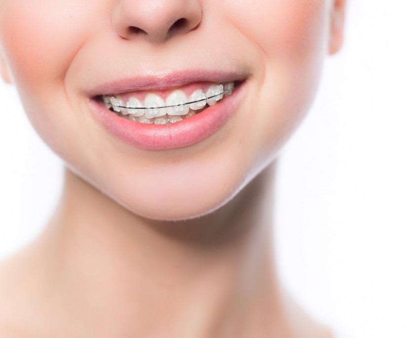 Ceramic brackets – Clear brackets - The Orthodontic clinic in Paphos